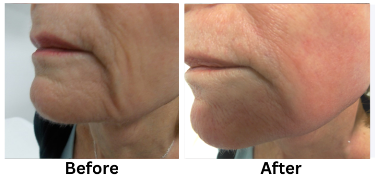 Skin Tightening Before and After Photos