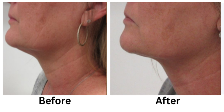 Skin Tightening Before and After Photos