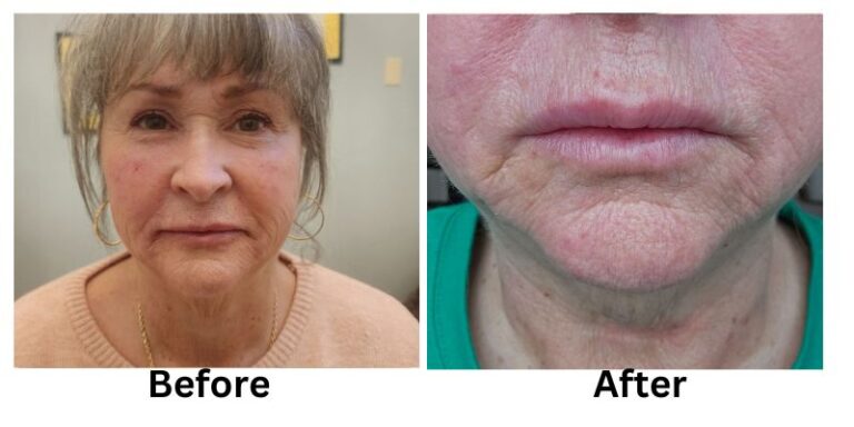 How Soon Will You Notice Changes After Starting HRT?