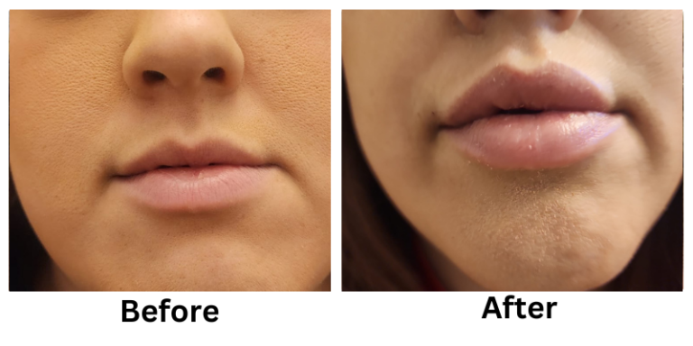 Is Dermaplaning Worth It? Pros and Cons