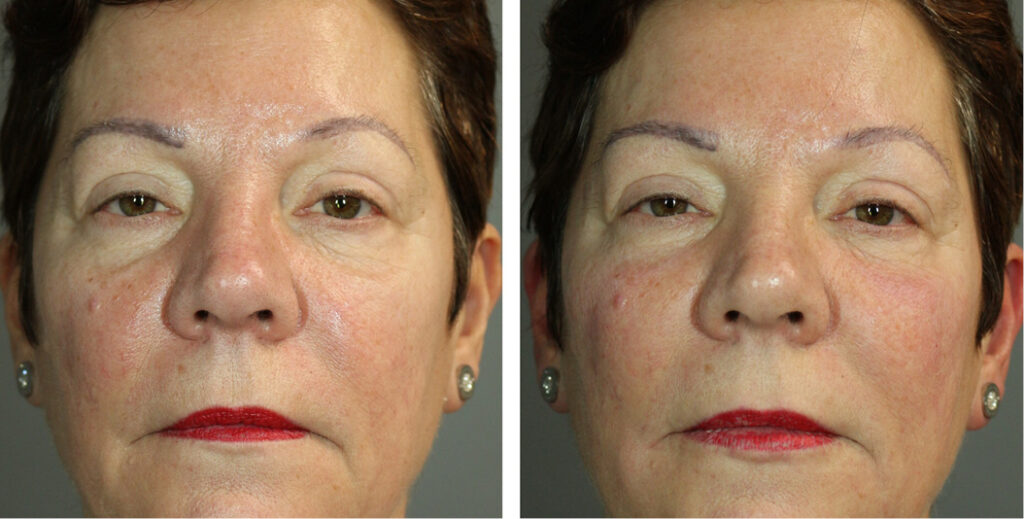 Can Dermal Fillers Make You Look Younger?